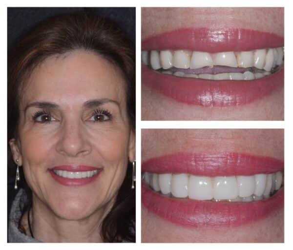 Bioclear - West Richmond Family Dentistry